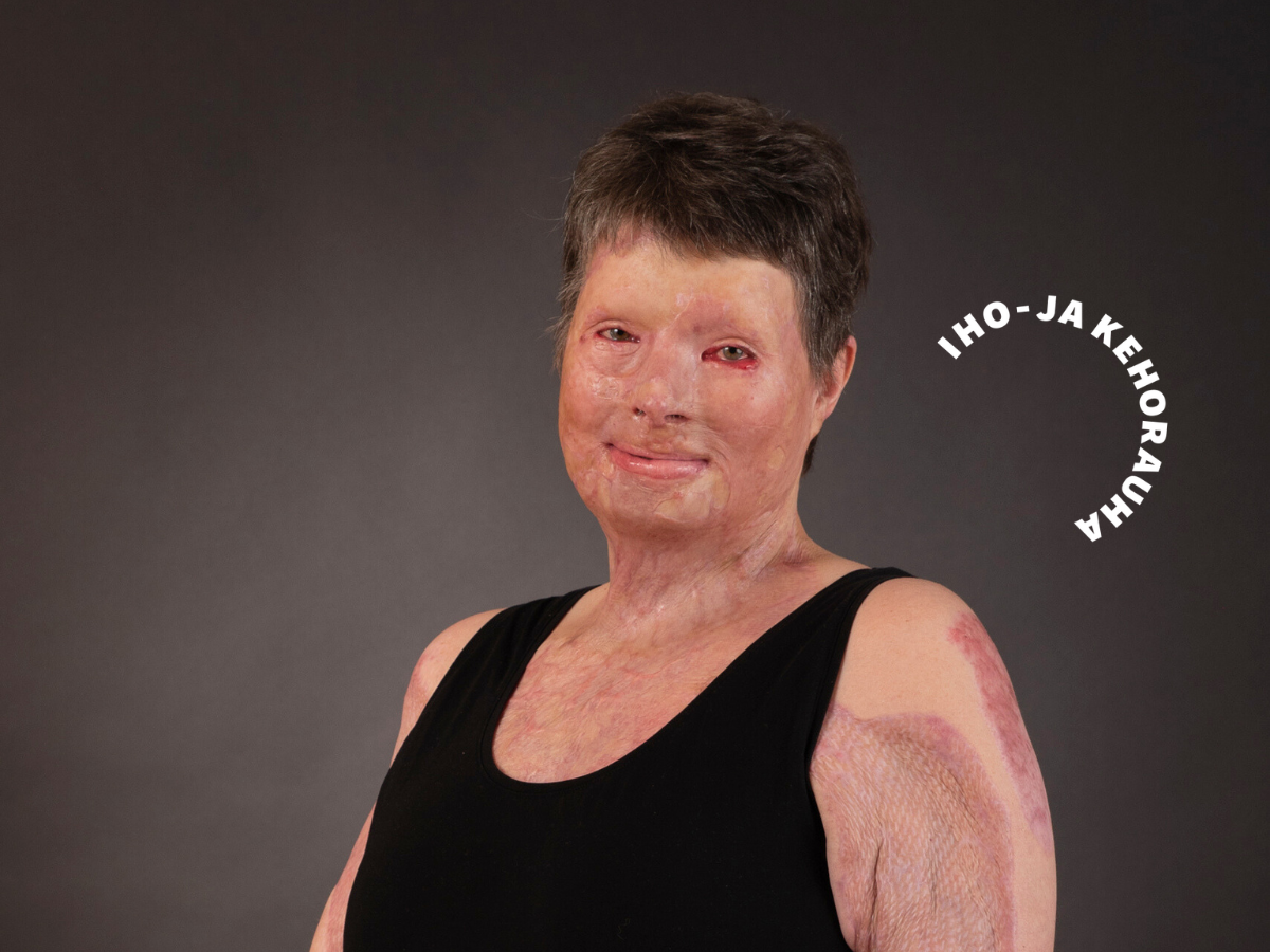 Tiina, palovamma - Allergia-, iho- ja astmaliitto